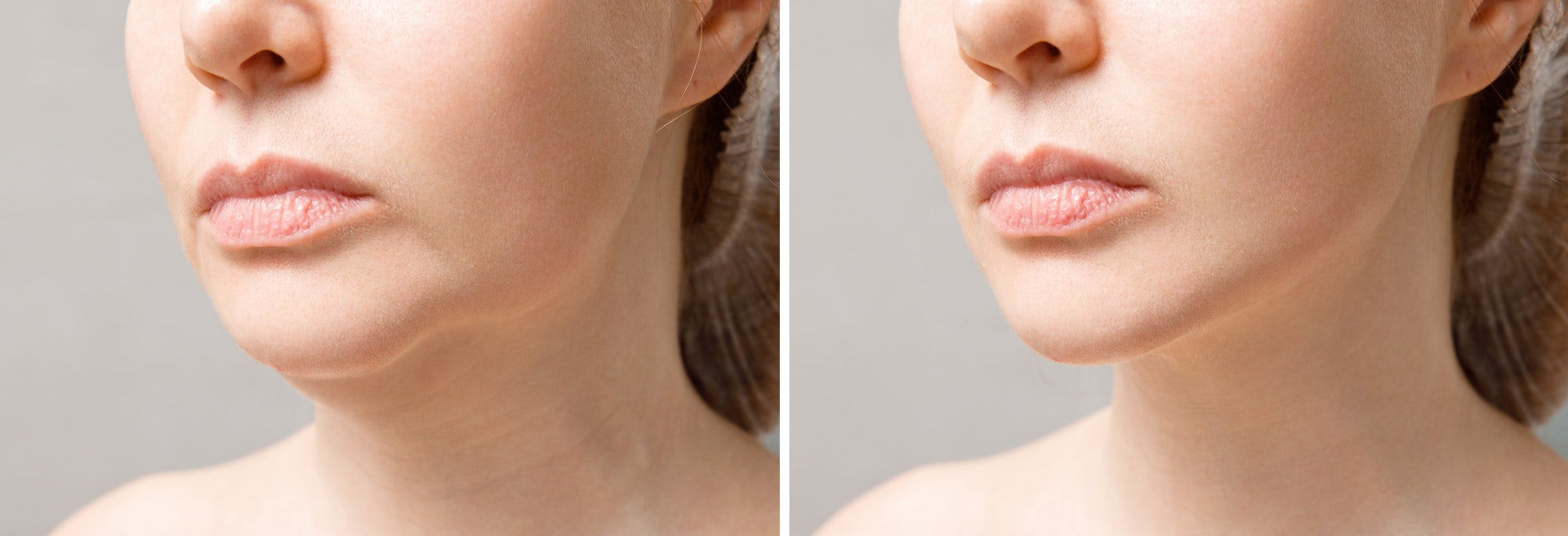Can a Chin Implant Improve Your Jawline?